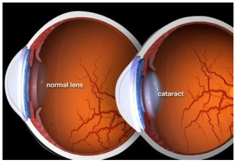 Understanding Your Options is Key to Dealing with Cataracts - Wisconsin ...